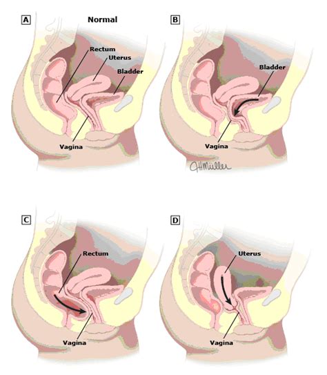 Dropped Bladder Surgery For Women
