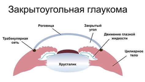 Закрытоугольная глаукома — причины, симптомы, лечение, операция в Киеве