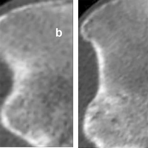 Computed Tomography Scans Showing The Process Of Ossification And
