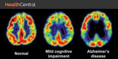 Natural Support For Alzheimers Dementia And Cognitive Function