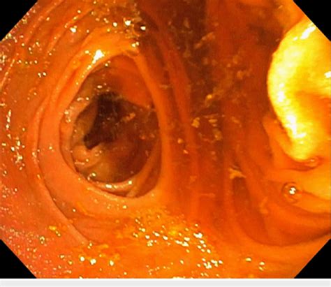 An Enteroscopic View Of The Gastric Lumen Download Scientific Diagram