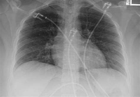 Continuous Diaphragm Sign