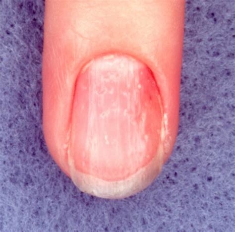 Nail Psoriasis Statpearls Ncbi Bookshelf