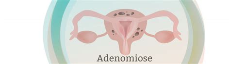 O que é adenomiose Centro de Reprodução Humana Wahib Hassan