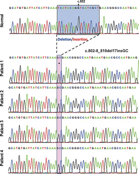 Genetic Analysis 4 Patients In Our Study Received Genetic Analysis