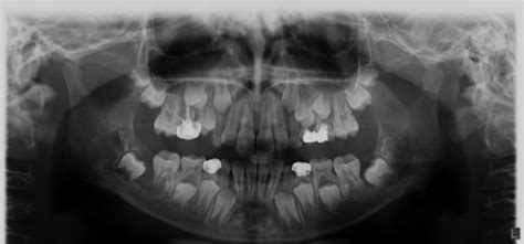 A Panoramic Image Shows The Bilateral Pericoronal Radiolucencies As A