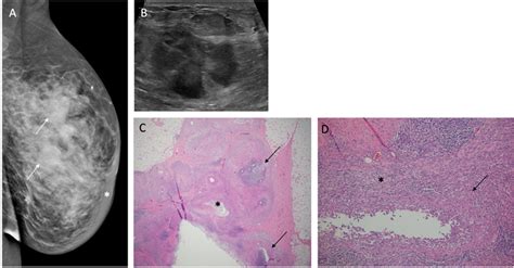 Cystic Neutrophilic Granulomatous Mastitis In A 48 Year Old Woman With
