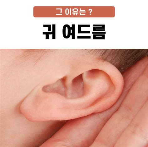 귀 여드름 그 이유는