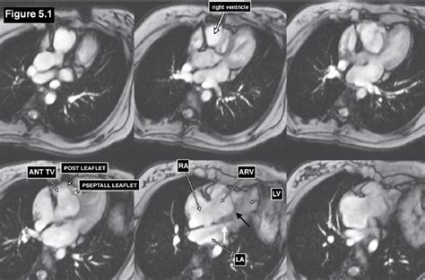 1 Ebsteins Anomaly Case The Gradient Echo Cine Mri On Four Chamber