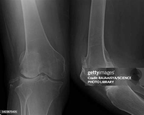 Osteoarthritis X Ray Photos And Premium High Res Pictures Getty Images