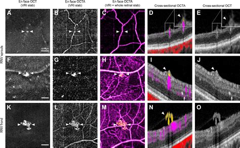 Early Sign Of Retinal Neovascularization Evolution In Diabetic
