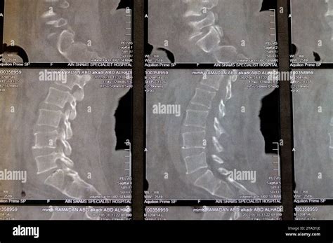 Cairo Egypt October 15 2023 Ct Scan Of Lumbo Sacral Spine Reveals