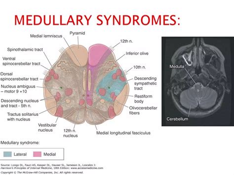 Posterior Circulation Stroke Pptx