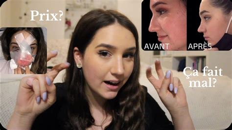 Ma Rhinoplastie Vlog Expérience Prix Conseils Youtube
