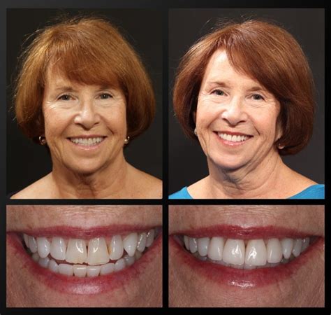 Smile Gallery Dr Jeff Haddad Rochester Advanced Dentistry