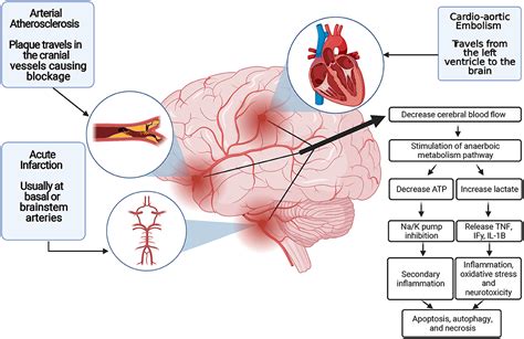 Acute Ischemic Stroke