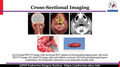 Comprehensive Management Of Recurrent Thyroid Cancer Ahns Endocrine