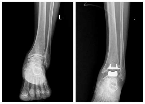Шагайн хиймэл үе солих мэс заслыг ГССҮТ ийн эмч нар эх орондоо нутагшууллаа Peak News