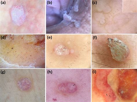 Vaginal Warts
