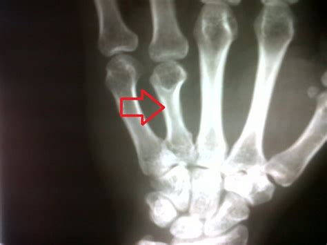 Point Of View Dx Fourth Metacarpal Bone Hypoplasia