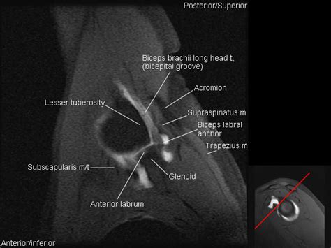 Shoulder Arthrogram
