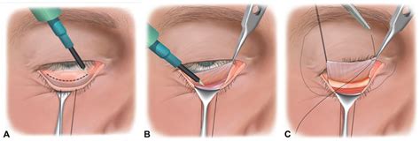 Transconjunctival And Transcaruncular Approaches To The Orbit Pmc