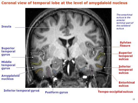 Inferior Temporal Sulcus