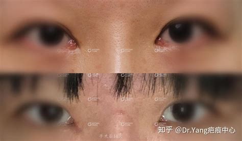 包眼角术后 知乎