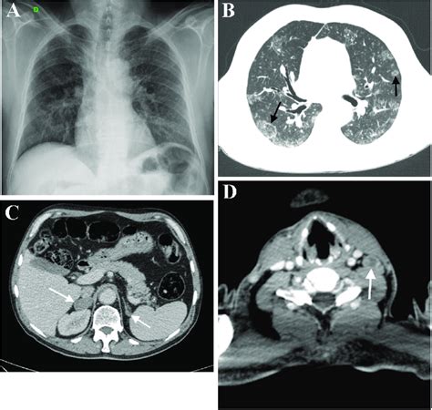 A Chest Radiograph Showed A Diffuse Reticulonodular Infiltrate B Download Scientific