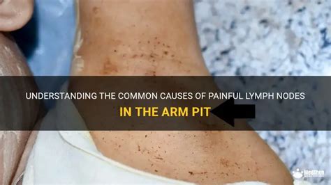 Understanding The Common Causes Of Painful Lymph Nodes In The Arm Pit