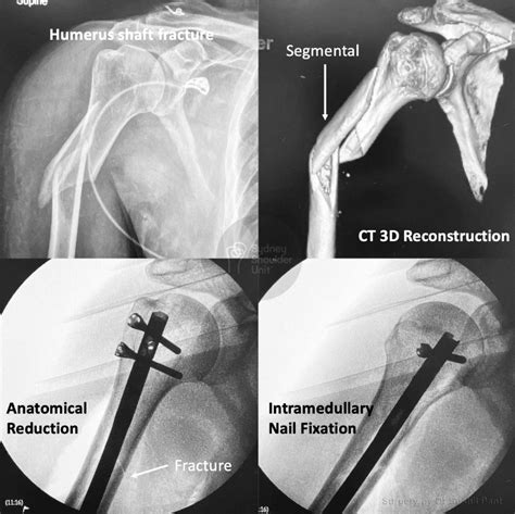 Range Of Motion After Proximal Humerus Fracture At Dianna Wagner Blog