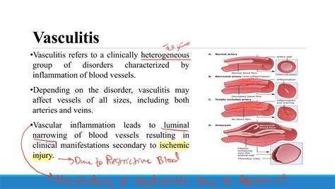 Vasculitispdf