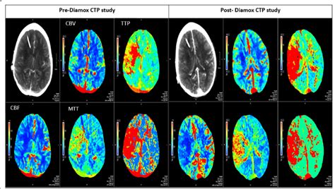 Pre Diamox Computed Tomographic Perfusion Ctp Study Showing A Large