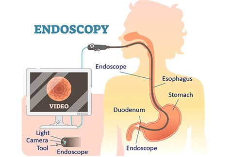 Upper Gi Endoscopy Johns Hopkins Medicine
