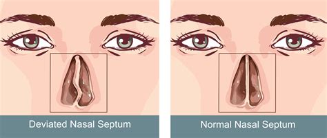 The Most Common Symptoms Of A Deviated Septum