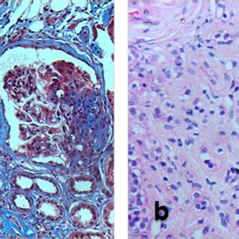 Diffuse Proliferative Lupus Nephritis LN WHO Class IV A Global