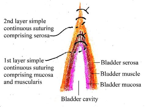 Bladder Injury Repair Done By Simple Continuous Suturing With