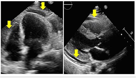 Initial Echocardiographic Findings Showing RV Diastolic Collapse And