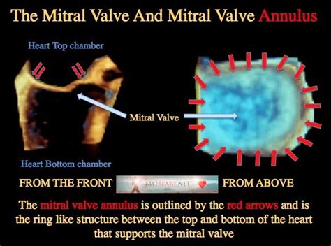 Mitral Annular Calcification Diagnosis Treatment And Risks