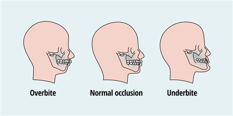 premium vector tooth problem side view man with misaligned teeth
