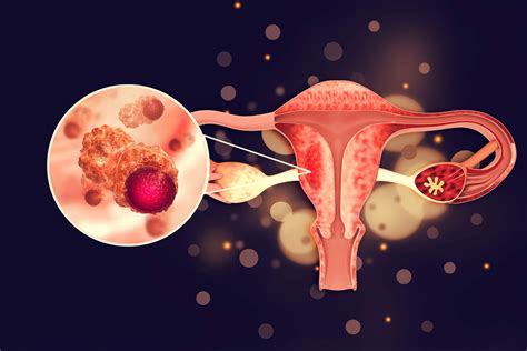 Asco 2024 New Insights Into Endometrial Cancer Treatment And Etiology
