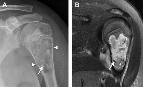 Shoulder Tumortumor Like Lesions Magnetic Resonance Imaging Clinics