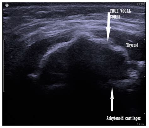 Jcm Free Full Text Airway Ultrasound For Anesthesia And In