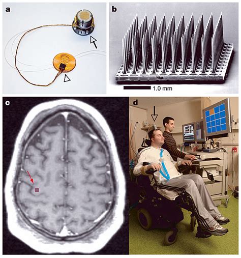 Intracortical Sensor And Placement Participant 1a The Braingate