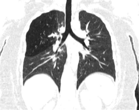 Thiruvasagan S On Linkedin Radiology Ctscan Radiopedia