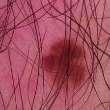 Github Joydip Basu Biswas Skin Cancer Detection Predicting The Skin