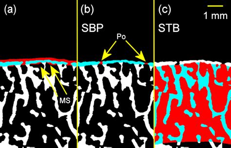Contouring Of The Subchondral Bone Plate Sbp And The Subchondral