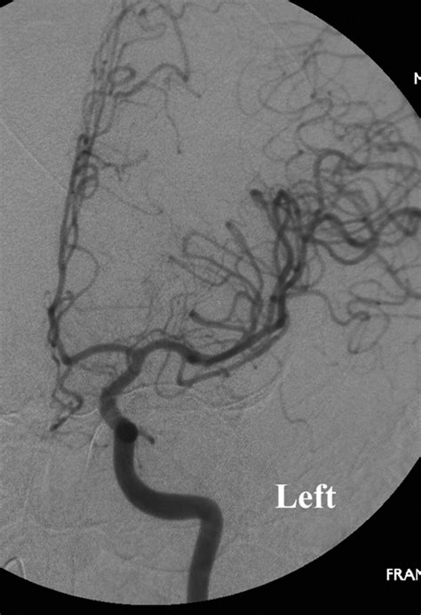 Ct Angiography In The Evaluation Of Cerebrovascular Diseases Ajr