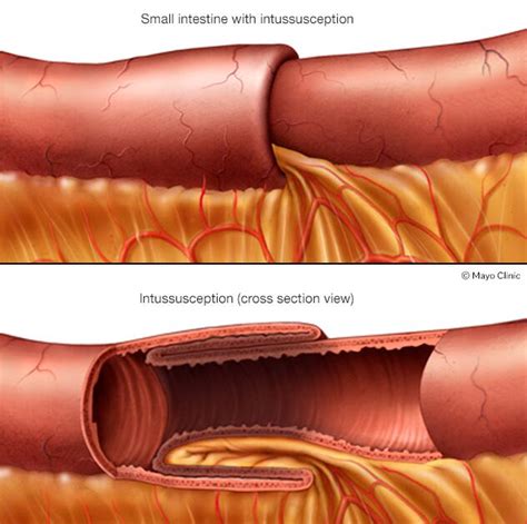 Imaging In Intussusception Sinaiem