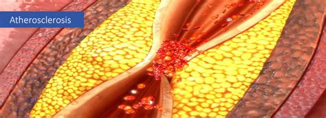 Atherosclerosis Gaavs